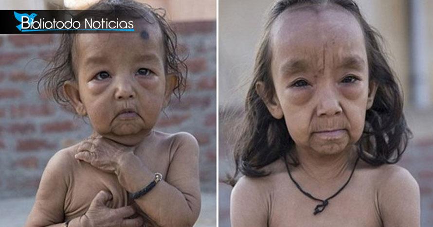 Increíble caso de dos niños que sufren la enfermedad del personaje ...